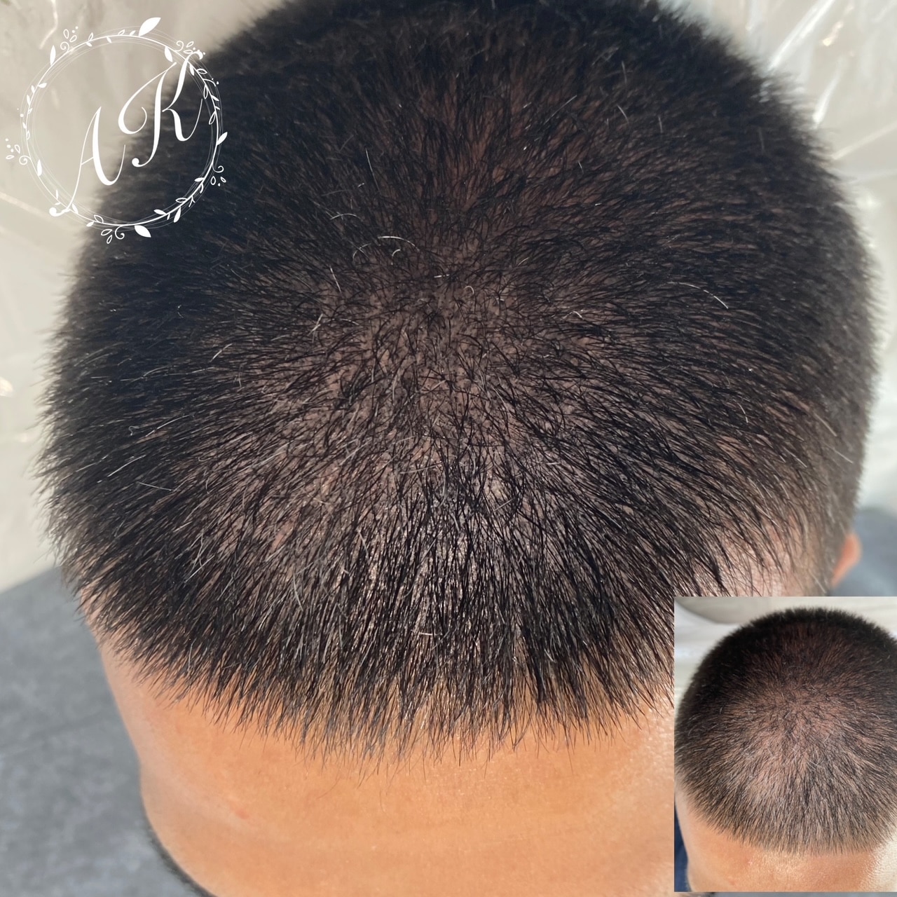 5 Benefits Of Scalp Pigmentation - Annette Kemp